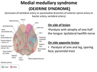 Medial Medullary Syndrome Usmle