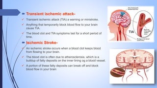 Brain Stroke PPT | PPTX