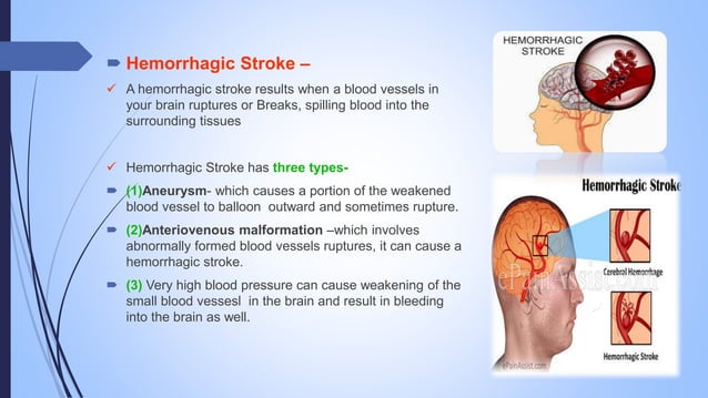 Brain Stroke PPT | PPTX | Brain and Nervous System Disorders | Diseases and Conditions