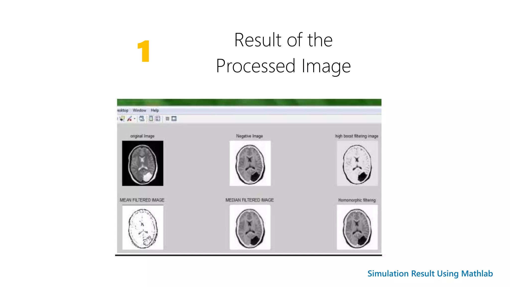 Brain Tumor Detection Using Image Processing | PPTX