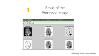 Brain Tumor Detection Using Image Processing | PPTX