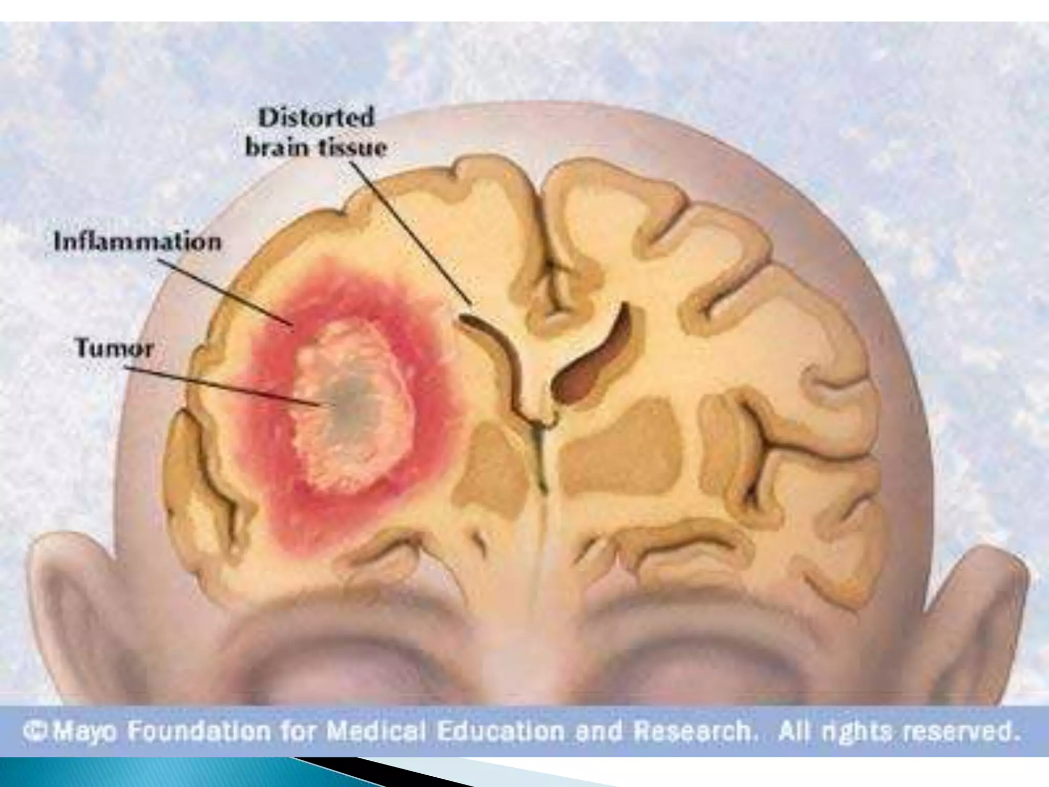 brain_tumor.pptx