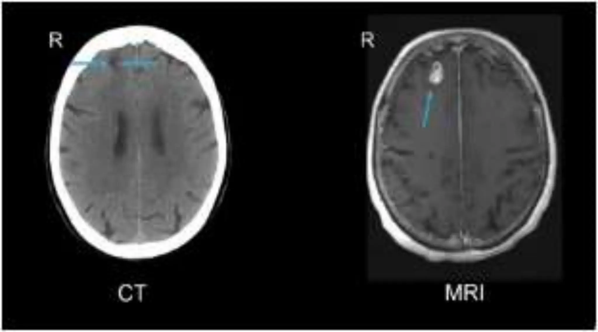 Brain tumour (Central Nervous System Tumour).pptx