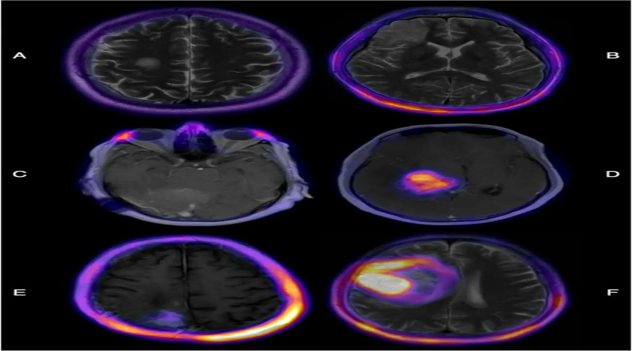 Brain tumour (Central Nervous System Tumour).pptx