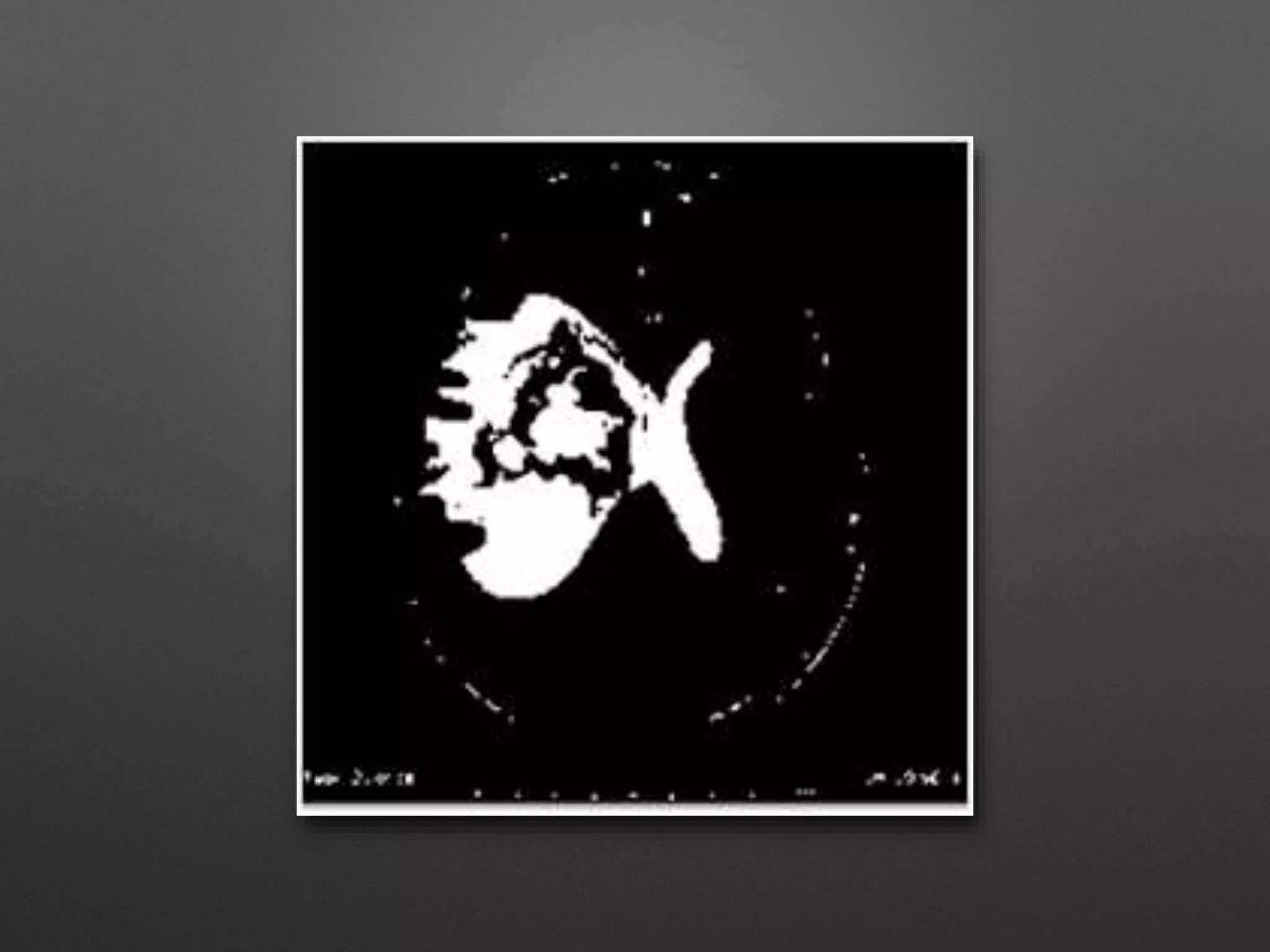 Brain tumor detection | PPTX