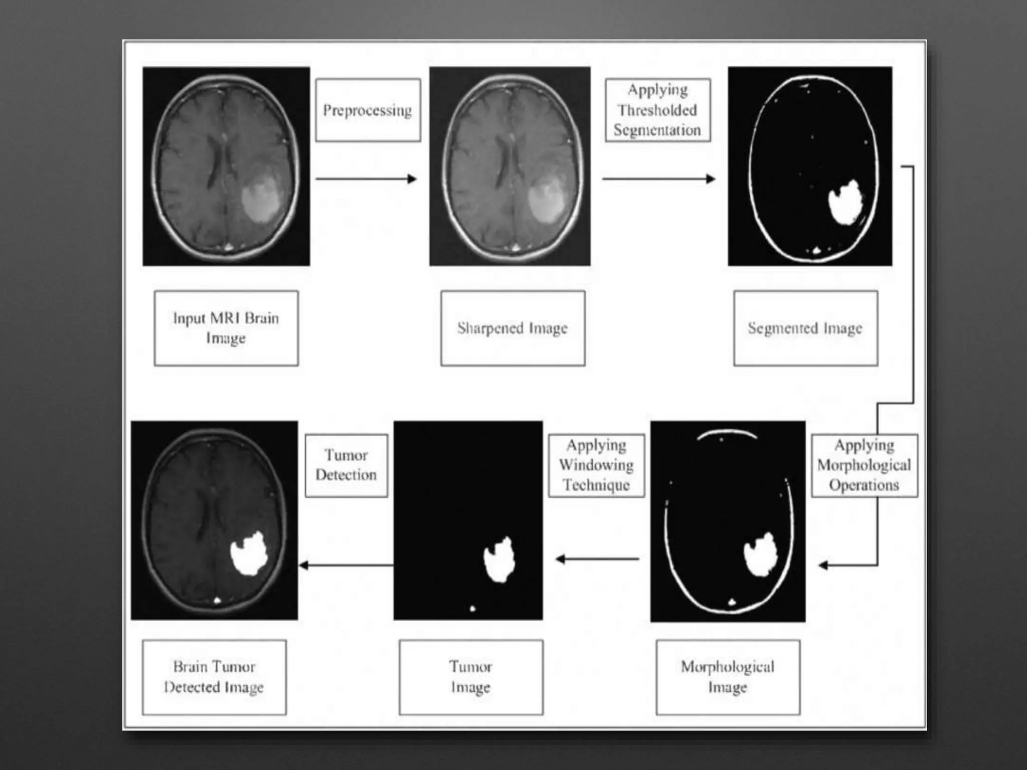 Brain Tumor Detection Ppt