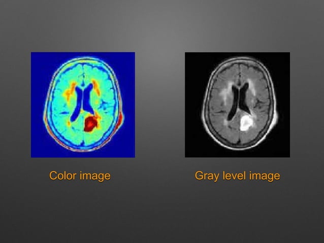Brain tumor detection | PPTX