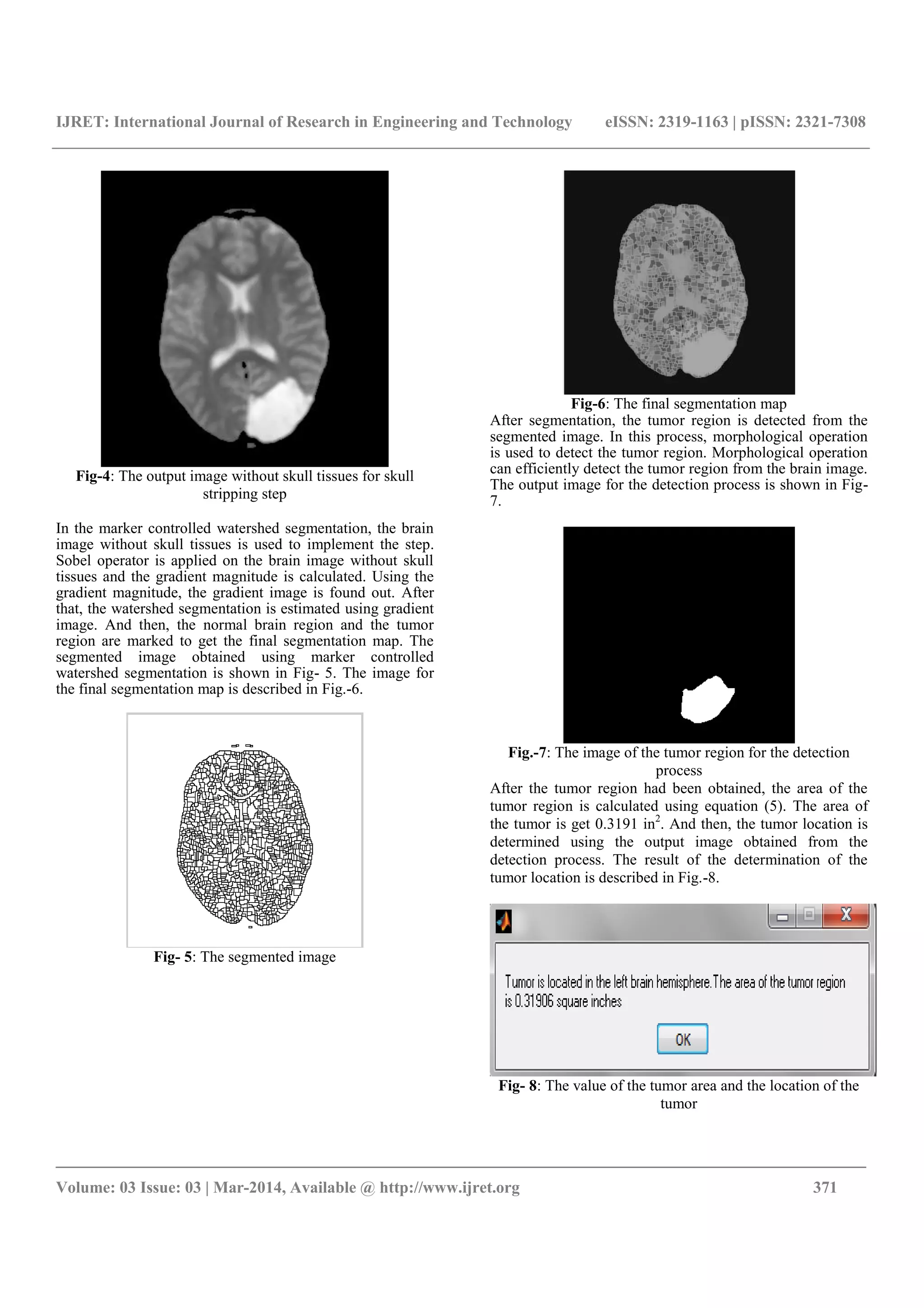 Brain Tumor Detection And Segmentation Using Watershed Segmentation And Morphological Operation