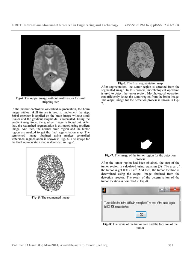 Brain Tumor Detection And Segmentation Using Watershed Segmentation And Morphological Operation