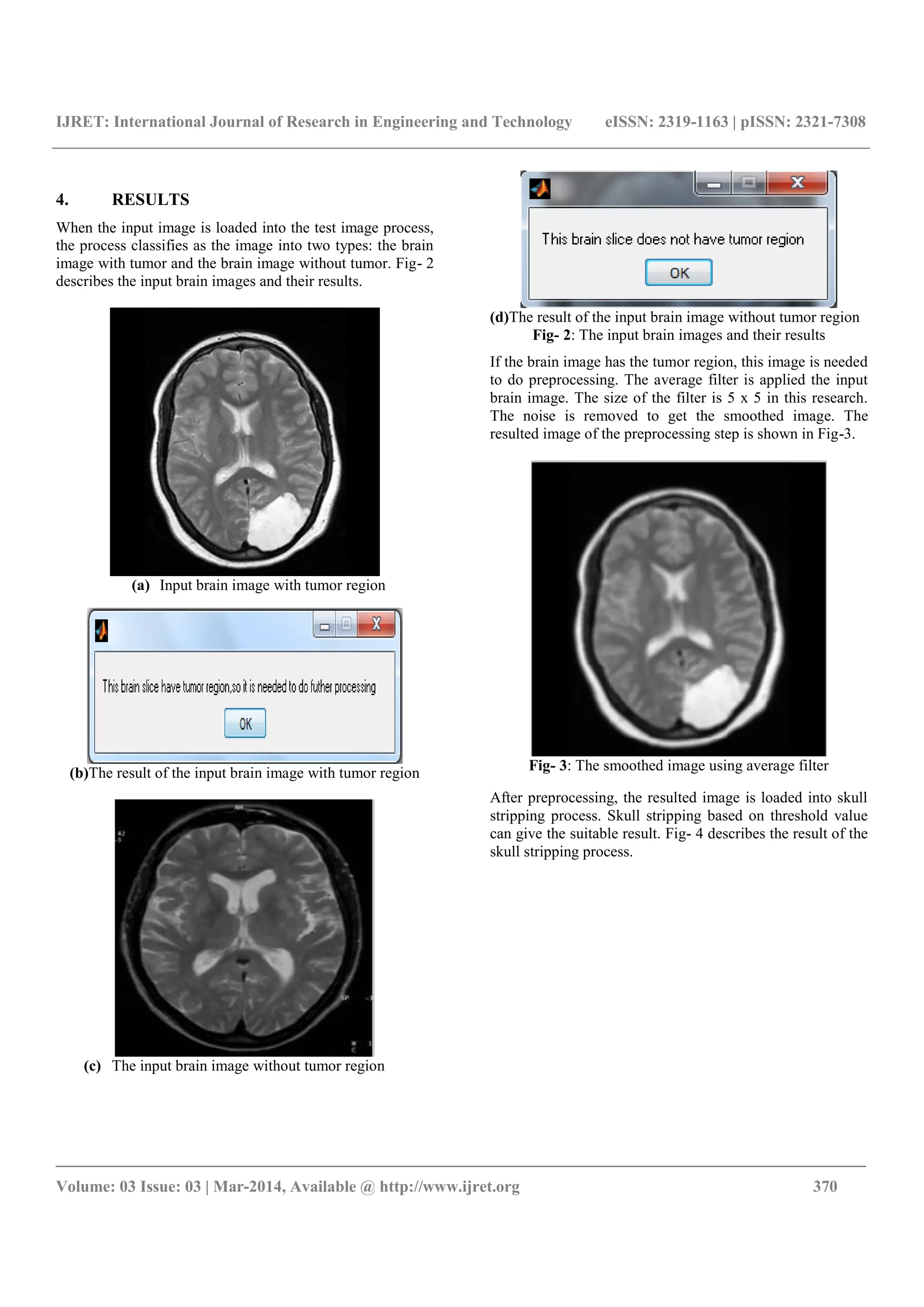 Brain Tumor Detection And Segmentation Using Watershed Segmentation And
