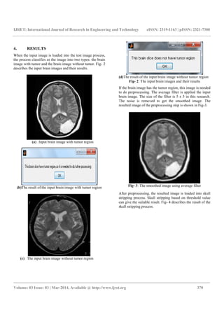 Brain tumor detection and segmentation using watershed segmentation and morphological operation ...