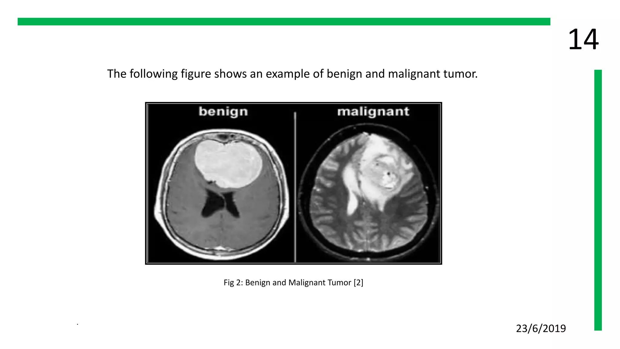 Brain tumor detection using convolutional neural network | PPTX