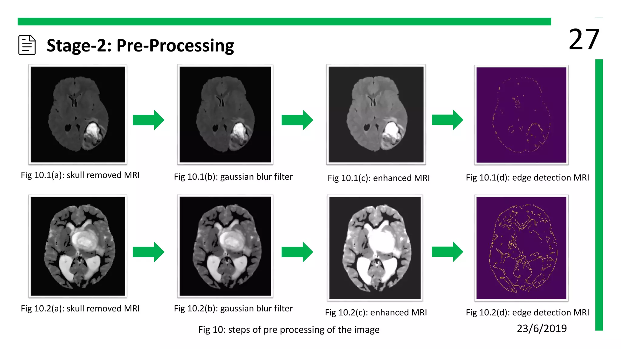 Brain Tumor Detection Using Convolutional Neural Network Pptx Brain