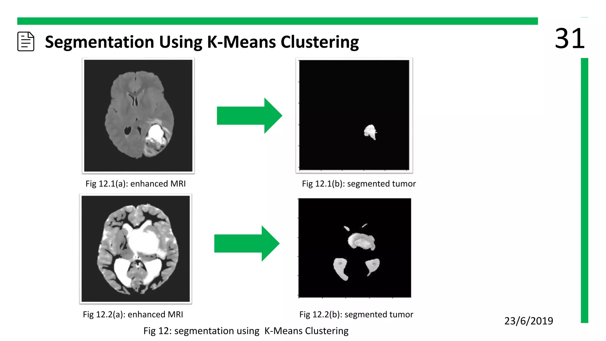 Brain Tumor Detection Using Convolutional Neural Network Pptx Brain And Nervous System