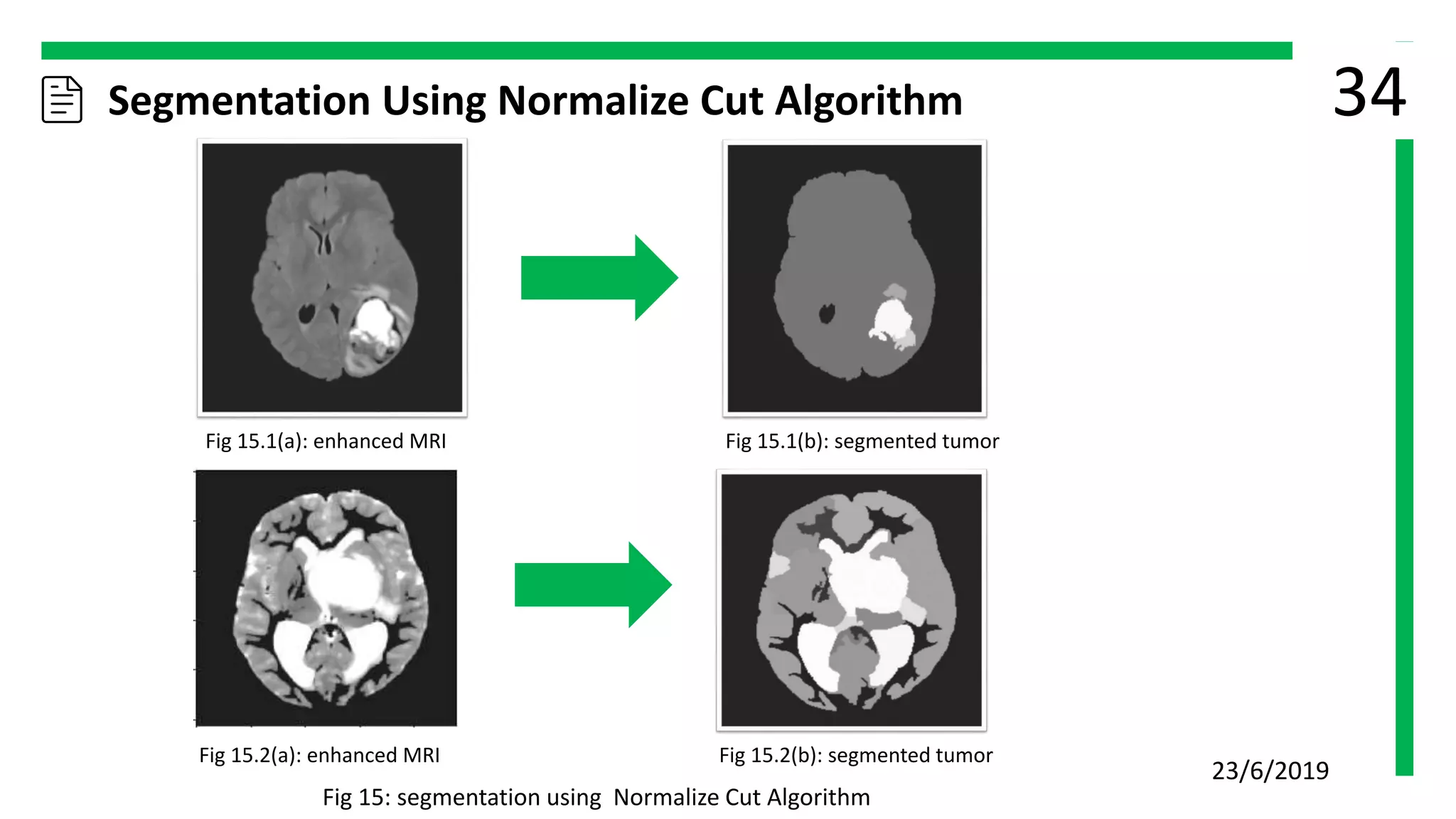Brain Tumor Detection Using Convolutional Neural Network Pptx Brain