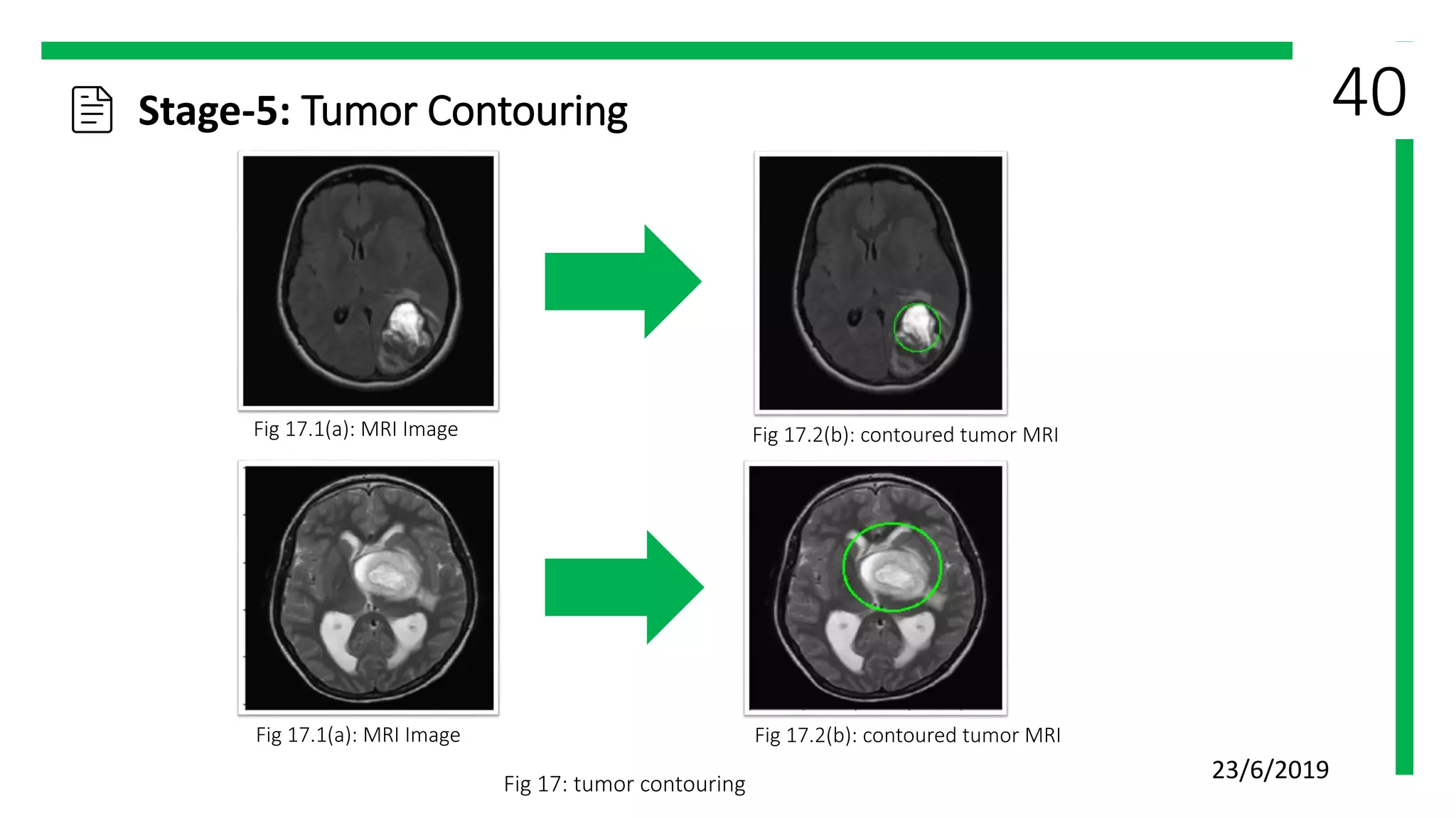 Brain Tumor Detection Using Convolutional Neural Network Pptx Brain