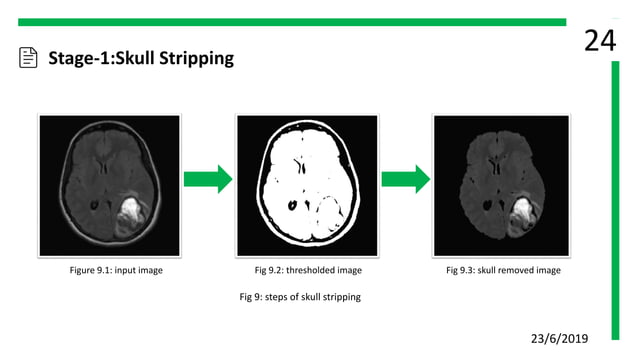 Brain tumor detection using convolutional neural network | PPTX | Brain ...