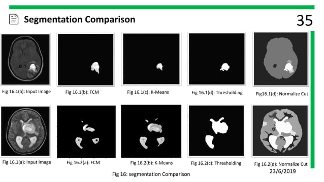 Brain tumor detection using convolutional neural network | PPTX | Brain ...