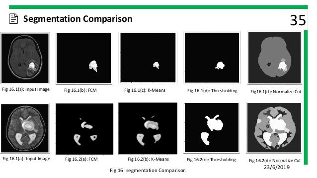 Brain Tumor Detection Using Convolutional Neural Network