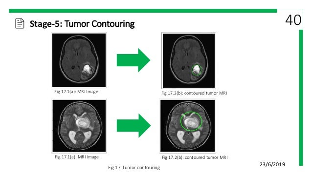 Brain Tumor Detection Using Convolutional Neural Network Cnn Matlab Vrogue