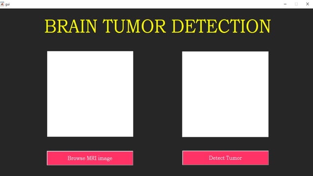 Brain Tumor Detection Using Image Segmentation Ppt Pptx