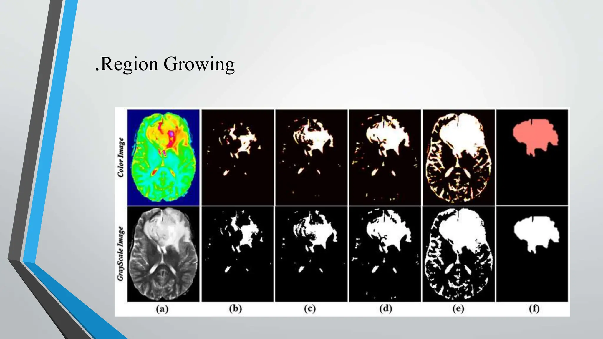Brain Tumor Detection With Machine Learning Pptx Brain And Nervous