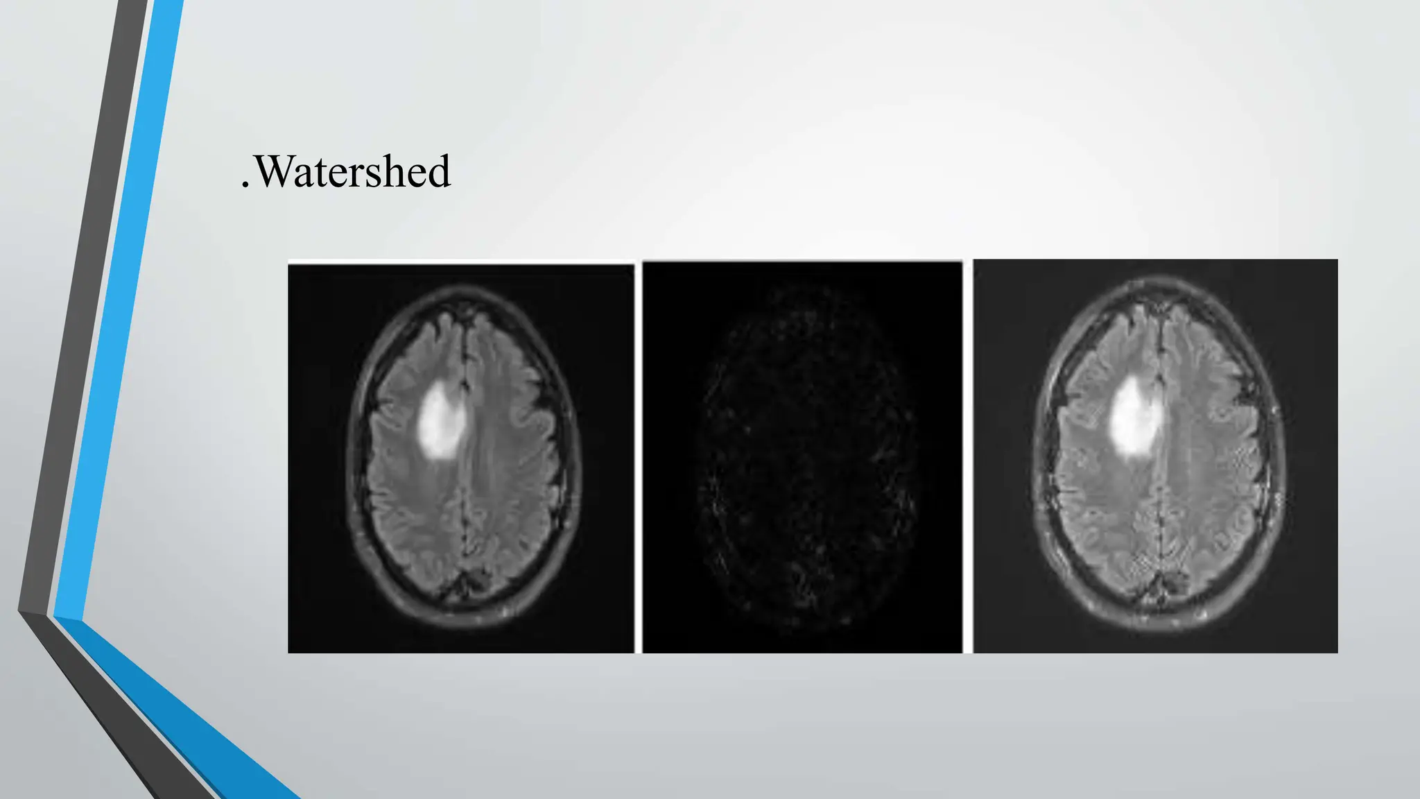 Brain Tumor Detection With Machine Learning Pptx Brain And Nervous