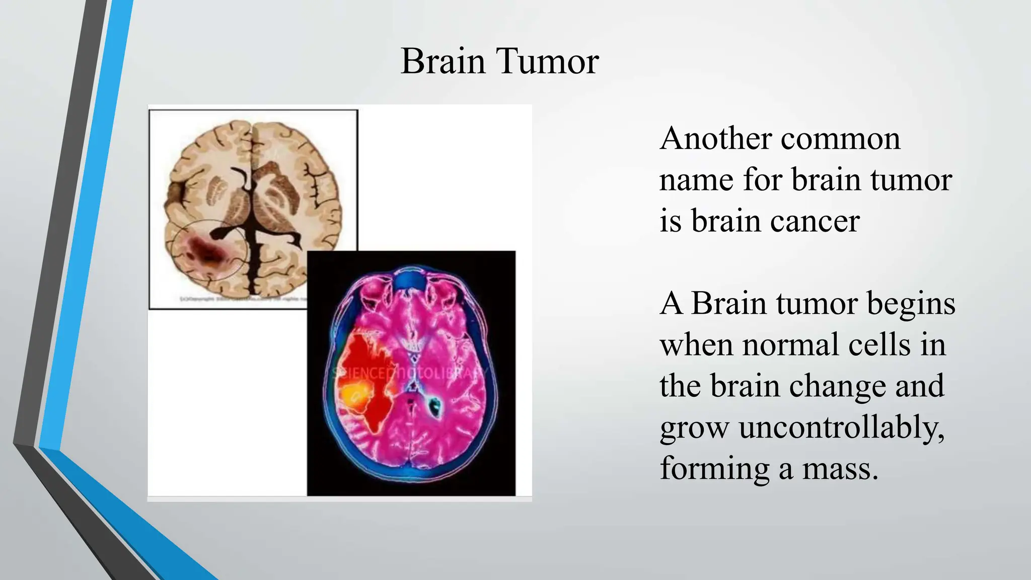 Brain Tumor Detection with Machine Learning.pptx | Brain and Nervous ...