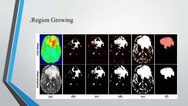 Brain Tumor Detection with Machine Learning.pptx | Brain and Nervous System Disorders | Diseases ...