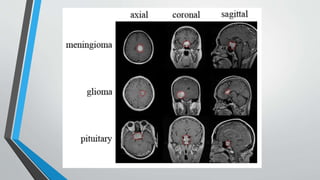 Brain Tumor Detection with Machine Learning.pptx