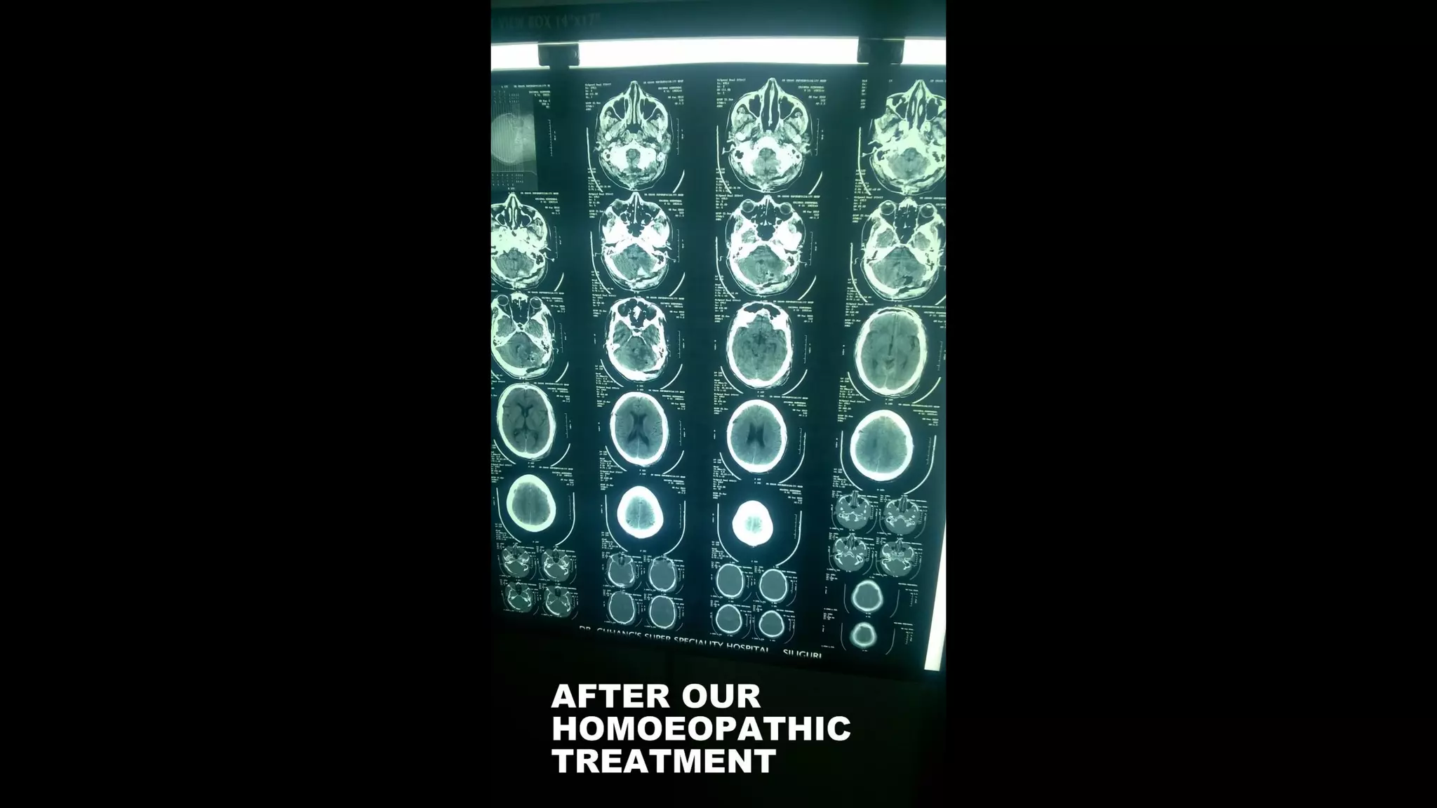 Brain Tumor, Left Cerebellar Tumor, SOL (Space occupying lesion ...