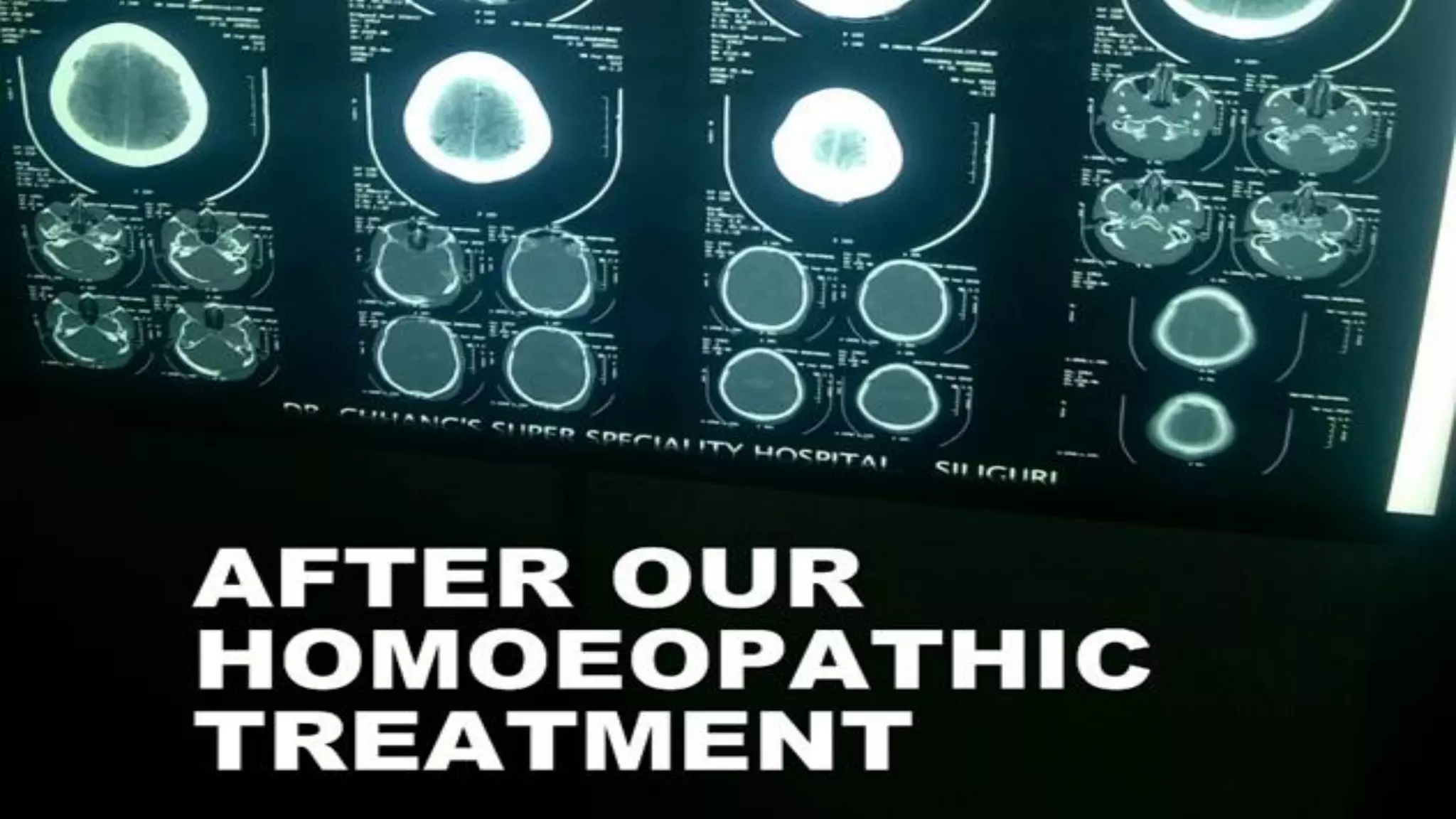 Brain Tumor, Left Cerebellar Tumor, SOL (Space occupying lesion ...