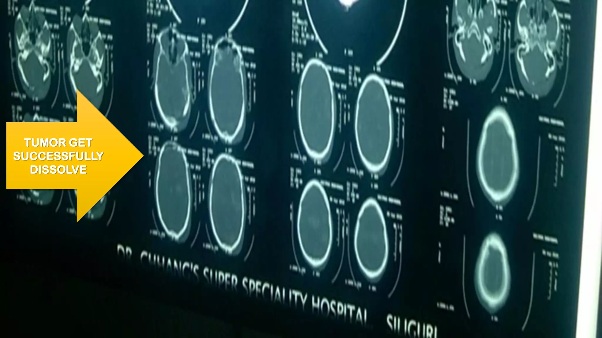 Brain Tumor, Left Cerebellar Tumor, SOL (Space occupying lesion ...