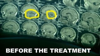 Brain Tumor, Left Cerebellar Tumor, SOL (Space occupying lesion ...