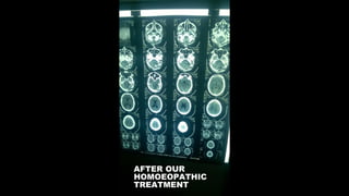 Brain Tumor, Left Cerebellar Tumor, SOL (Space occupying lesion ...
