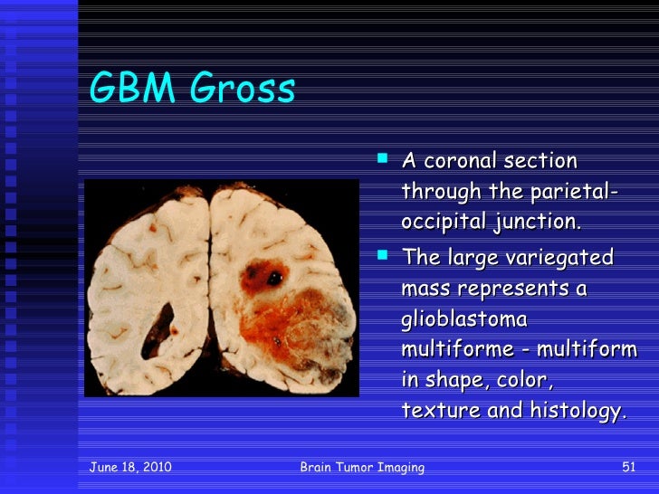 Brain tumor imaginig 2 3rd may 02