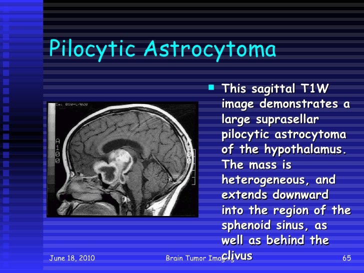 Brain tumor imaginig 2 3rd may 02