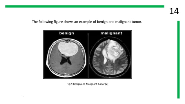 brain tumor ppt.pptx