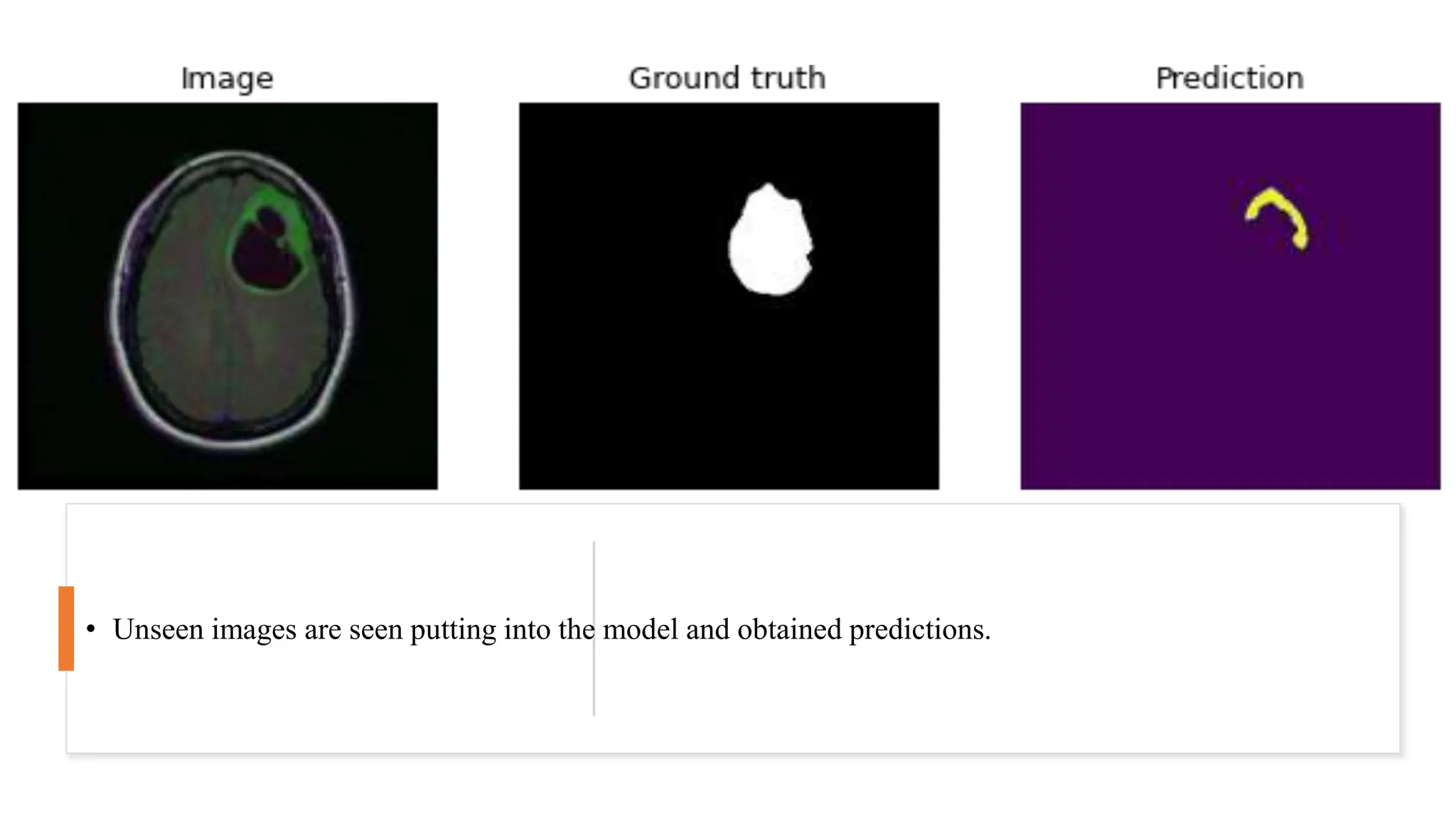 brain tumor presentation.pptxbraintumorpresentationonbraintumor | PPTX