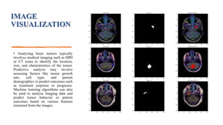 brain tumor presentation.pptxbraintumorpresentationonbraintumor | PPTX