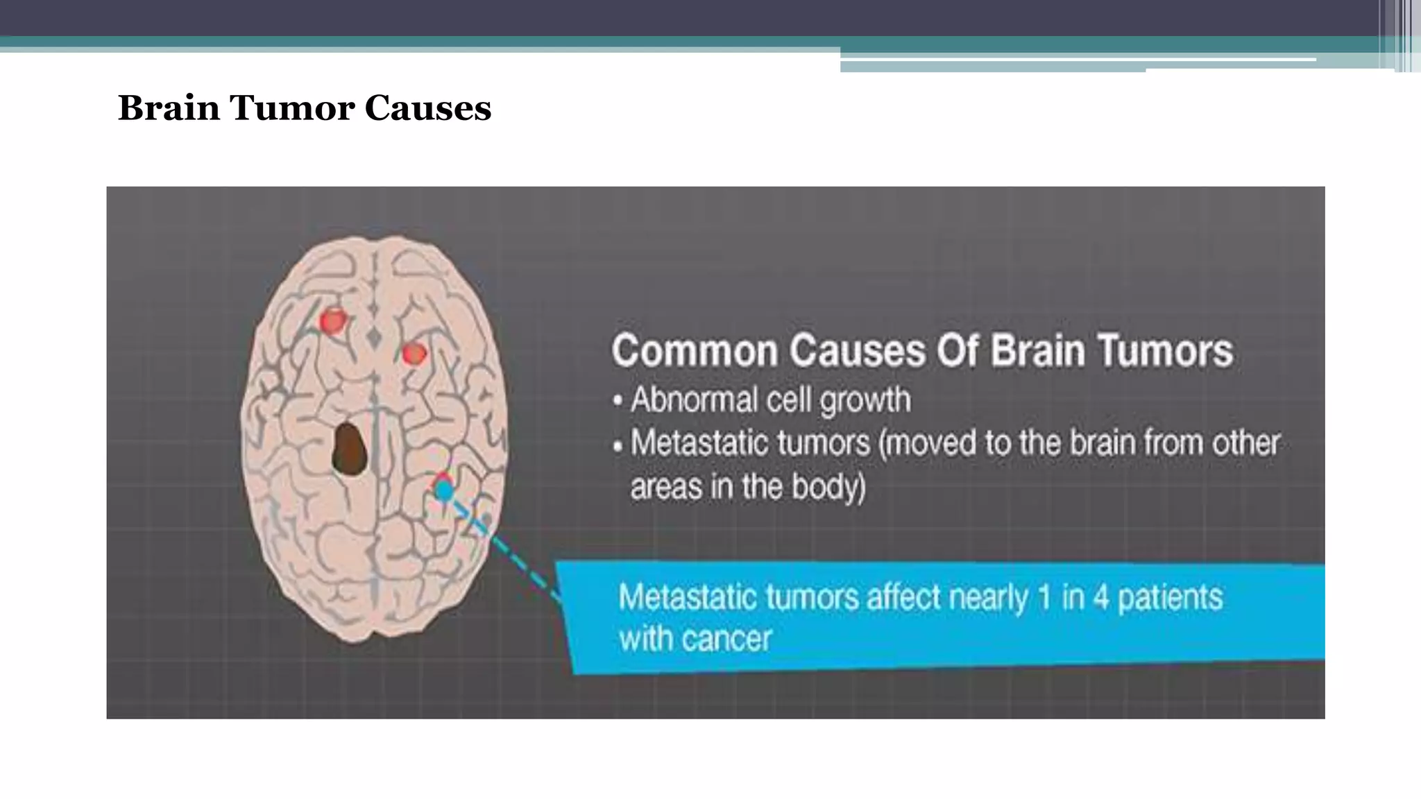 brain tumors.pptx