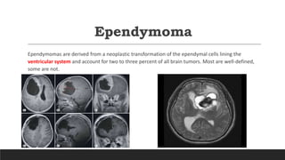 brain tumors.pptx