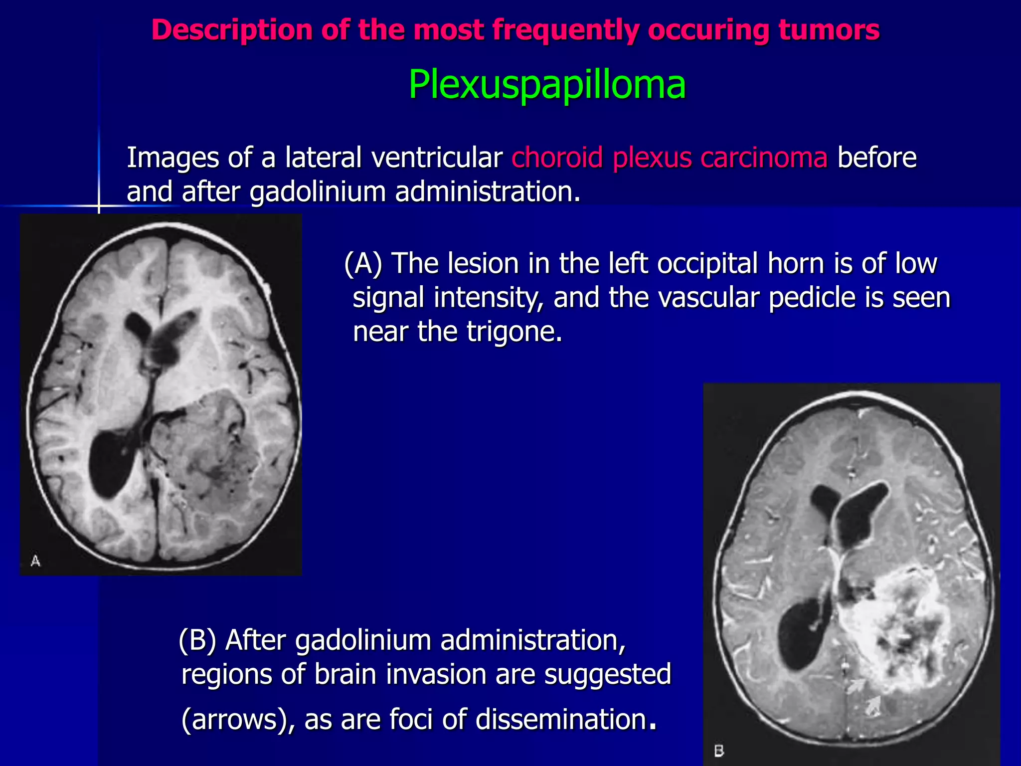 Brain Tumors.ppt