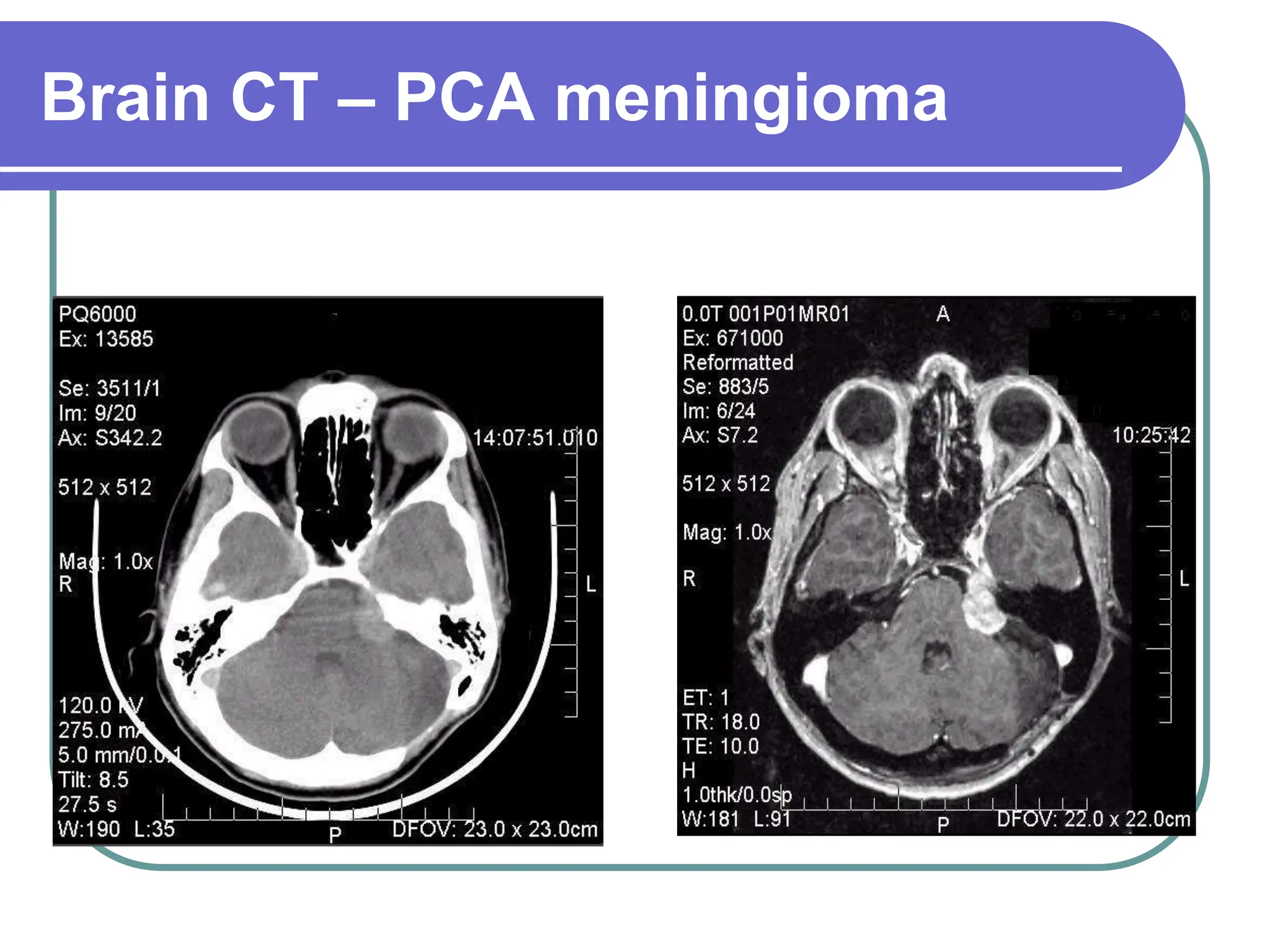 Brain Tumors Pathology and Management.ppt