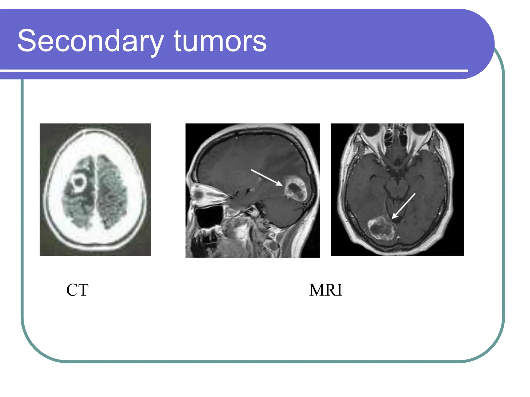 Brain Tumors Pathology and Management.ppt