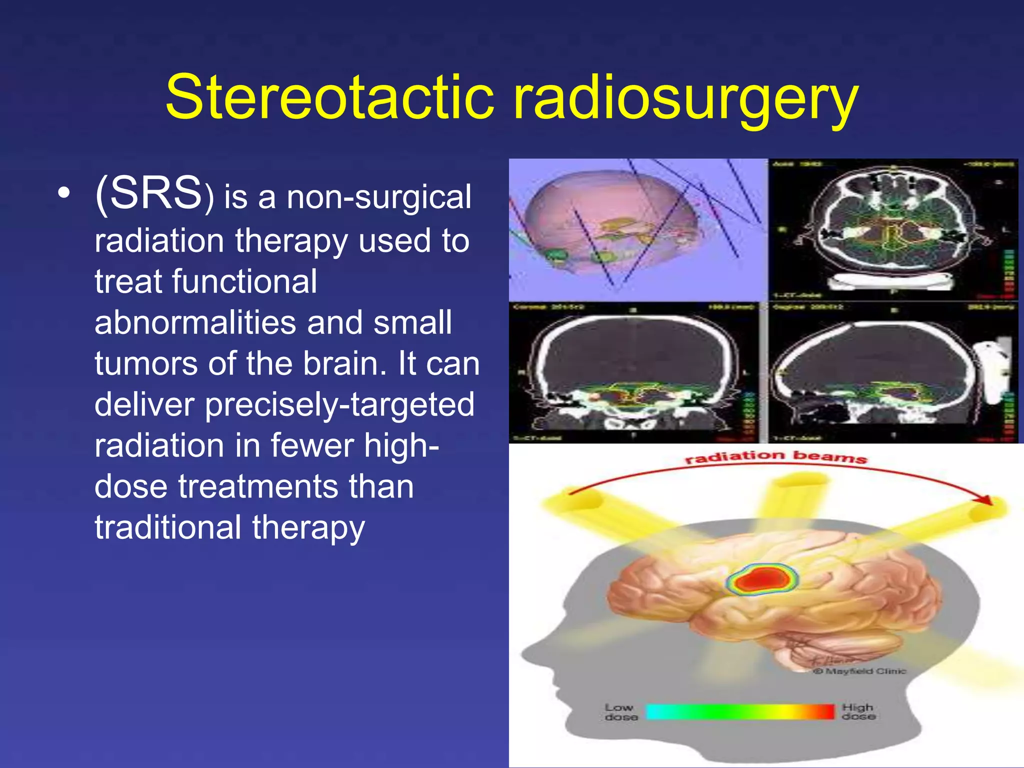 Brain tumors Radio diagnosis and therapy | PPTX