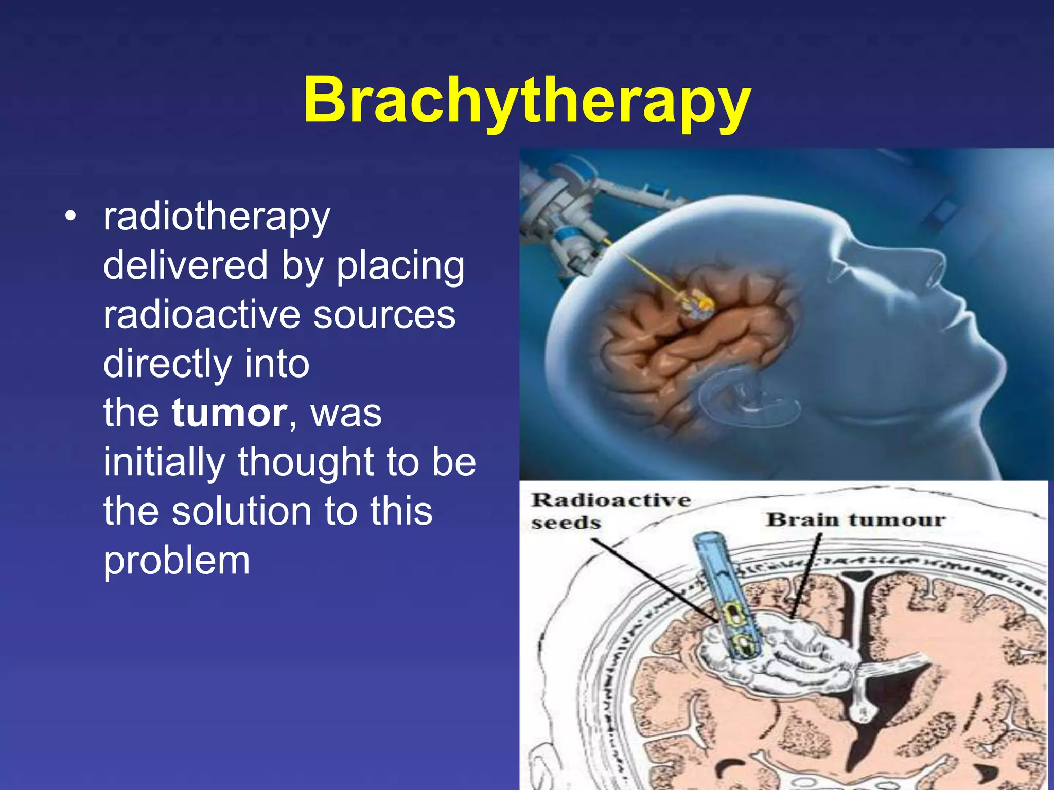 Brain tumors Radio diagnosis and therapy | PPTX