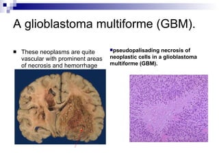 Brain tumors 2 | PPT
