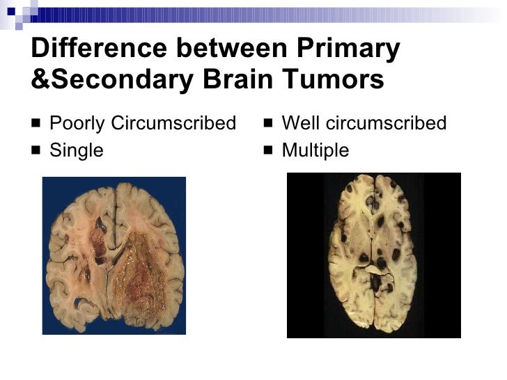 Brain tumors 2