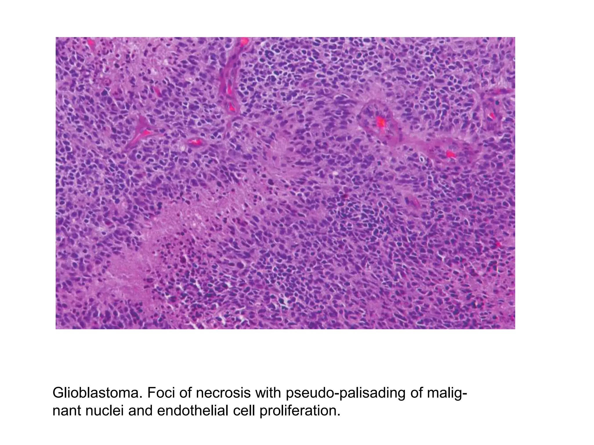 Brain tumors Bs Nursing and sign and symptoms | PPT